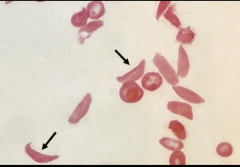 Sickle Cells